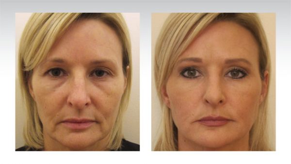 BaseLift™: The Non-Surgical Face Lift - fountainof30.com