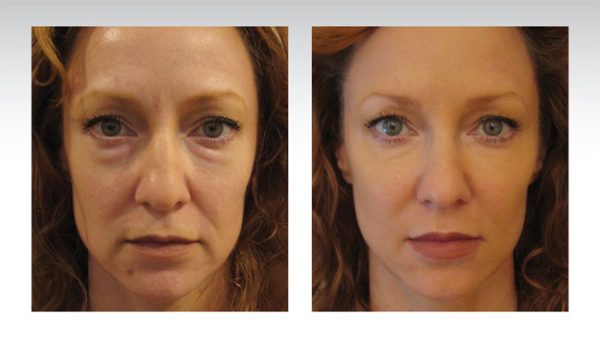 BaseLift™: The Non-Surgical Face Lift - fountainof30.com